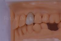 China 3 Shape Exo Design Digital Dental Crowns 1 Day Delivery Any Size Custom Fit for sale