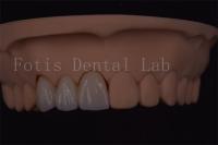 China FDA ISO CE Certified Digital Dental Crowns 1 Day Production Various Sizes for sale