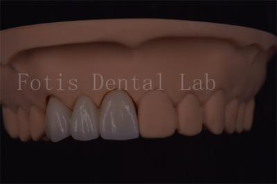 China FDA ISO CE Certified Digital Dental Crowns 1 Day Production Various Sizes for sale