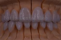 China FDA/ISO/CE Certified Digital Crown Teeth Artificial Crown Any Size for sale