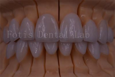 China FDA/ISO/CE Certified Digital Crown Teeth Artificial Crown Any Size for sale