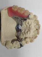 China Customizable Removable Partial Denture Co Cr PEEK FDA ISO 1pc for sale