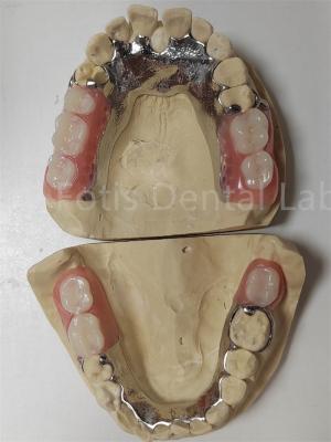 China Custom Removable Partial Denture Co Cr PEEK Flexible Adjustable Stable Fit for sale