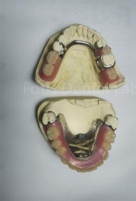 China PEEK Removable Partial Denture Customizable Size Flexible Design for Missing Teeth for sale