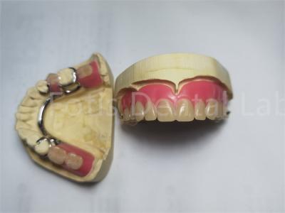 China PEEK Removable Partial Denture Customizable Size Comfortable Fit for Missing Teeth for sale