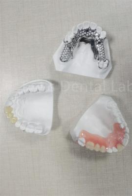 China Customizable Co Cr Removable Partial Denture for Replacing Missing Teeth Durable and Adjustable for sale