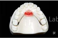 China Adjustable Mouth Expanding Retainer For Safe Teeth Retention And Expansion for sale