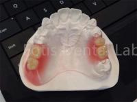 China Flexible TCS Valplast Dental Appliances Comfortable Durable Design for sale