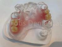 China Hypoallergenic Stain Resistant TCS Valplast Flexible Partial Dentures for Comfort for sale