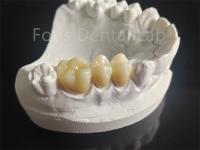 China Zirconia Layered Porcelain Dental Crown Bridge 16 Shade Aesthetic Restoration for sale