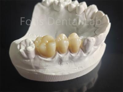China Zirconia Layered Porcelain Dental Crown Bridge 16 Shade Aesthetic Restoration for sale