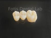 China High Strength Porcelain Layered Zirconia 900-1200 MPa for Durable Dental Bridges for sale