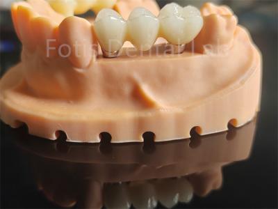 China Zirconia Layered Porcelain Dental Crown Bridge 1200 MPa Flexural Strength for sale