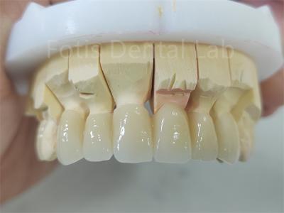 China Zirconia Ceramic with Porcelain Full Contour Dental Crown Bridge 900-1200 MPa for sale