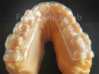 China Custom Fit Hard Dental Guard for Teeth Grinding Protection Dual Layer 2mm for sale