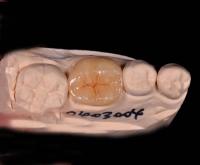 China Custom Dental Porcelain Onlay Inlay Indirect Restoration Tooth Colored Filling for sale