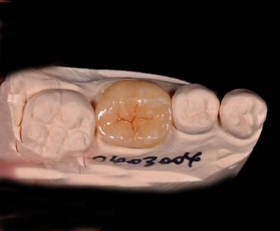 China Custom Dental Porcelain Onlay Inlay Indirect Restoration Tooth Colored Filling for sale