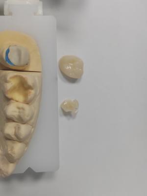 China Dental Ceramic Inlay Onlay Indirect Restoration Tooth Colored Filling 2mm for sale