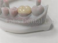 China Dental Porcelain Onlay Inlay Indirect Restoration Tooth Colored Filling 2mm for sale