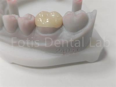 China Dental Porcelain Onlay Inlay Indirect Restoration Tooth Colored Filling 2mm for sale