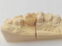 China Dental Ceramic Onlay Inlay CAD CAM Indirect Restoration Tooth Colored Filling 2mm for sale
