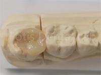 China Dental Lab Porcelain Onlay Inlay Indirect Restoration Tooth Colored Filling 10 Year Longevity for sale