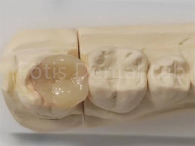 China Dental Lab Porcelain Onlay Inlay Indirect Restoration Tooth Colored Filling 10 Year Longevity for sale
