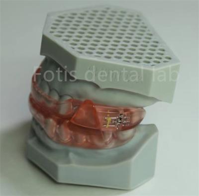 China Orthodontic Retainer Expander One Size Fits All Easy Clean Maintain for sale