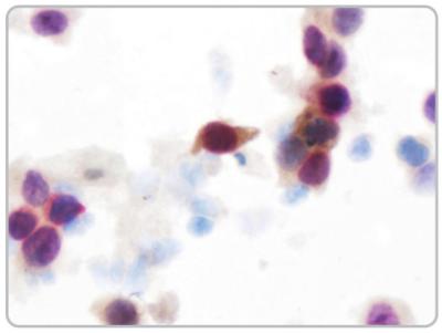 China Cervical Cancer Screening ICC Immunoassay Test Kit Cap Asccp p16 / Ki-67 CE for sale