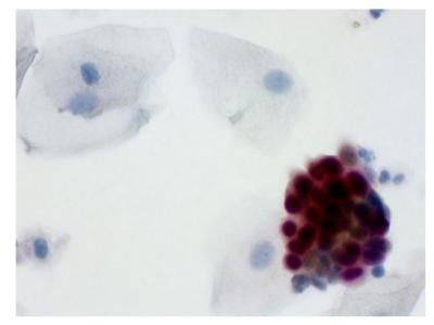 China Immunoassay Powerful Biomarkers IHC Staining Kit For Cervical Cancer Screening for sale