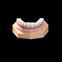 China Customize Hybrid Dental Implants Hybrid Denture With Titanium Bar for sale