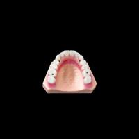 China Implanting Immediate Load Dentures Light Pink Removable Artificial Teeth for sale