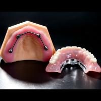 China All On X Implant Titanium Bar With Removable Denture for sale