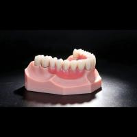 China Metal Framework Precision Attachment Overdenture Removable Tooth Denture for sale