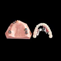 China Telescope Metal Crown And Bridge For Dental And Orthodontic for sale