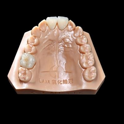 China Lava Crown And Bridge High Accuracy for sale