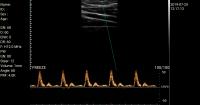 China Wireless Linear Probe High Frequency Probe Special Tool for Visual Puncture Guidance Integrated Handheld Ultrasound Scanner for sale