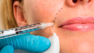 China 50ml Injectable Hyaluronic Acid Dermal Facial Chin Filler With Lidocaine PCL Plla Filler Injection for sale