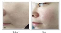 China 350mg 150mg PLLA Dermal Filler OEM Customization Injectable Plla For Long Lasting Results for sale