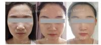 China Hyaluronic Acid PCL Skin Booster Miracle Touch Up Skin Collagen Stimulator for sale