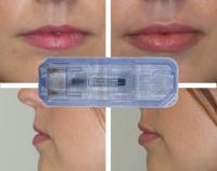 China CE Injectable Crosslinked Hyaluronic Acid Dermal Filler 24mg/mL Lip Injection 1mL for sale