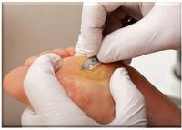 China 15W Podiatry Laser 980nm Diode Laser Treatment for Toenail Fungus Pain Relief for sale