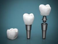 China Duable Dental Implant Screw Set Titanium Medical Screw for sale