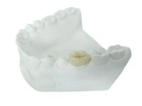 China Durable FDA All-Ceramic Dental Crown Veneer Inlay Onlay Similar for sale