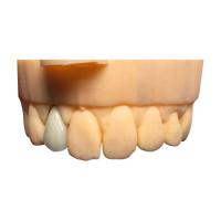China Chromecast Safety PFM Dental Crown Bridge Good Biocompatibility for sale