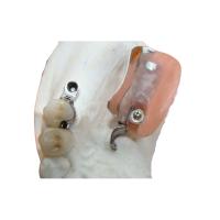 China Dental Lab Long Lasting Precision Attachment Denture Stain Resistant for sale