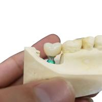 China Redefining Aesthetics Our Natura Looking Dental Implant Crowns for sale