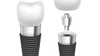 China Titanium / Cobalt Chromium Dental Implant Rod Comfortable Highly Biocompatible Implant for sale