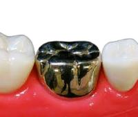 China High Hardness Gold Implant Crown Precious Metal Crown Corrosion Resistance for sale