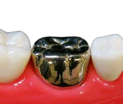 China High Hardness Gold Implant Crown Precious Metal Crown Corrosion Resistance for sale